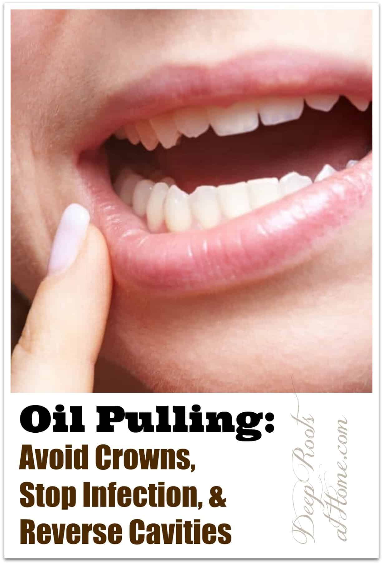 Real Life Oil Pulling: Avoid Crowns, Stop Infection & Bleeding Gums